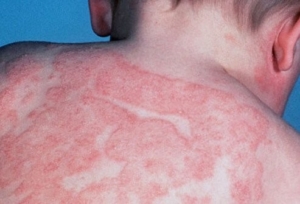 6 Common Newborn Rashes - Utah Valley Pediatrics