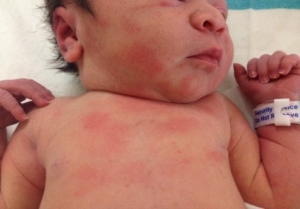 6 Common Newborn Rashes - Utah Valley Pediatrics
